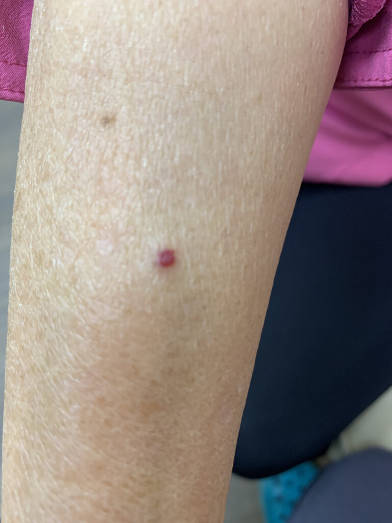 The Important Skin Cancer 1, 2, 3’s and A, B, C’s | GetSkinHelp